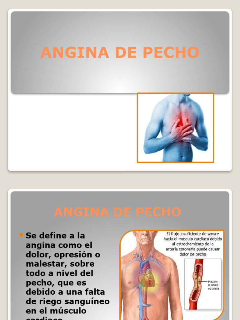 Tipos y síntomas de angina de pecho | PDF | Infarto de miocardio ...