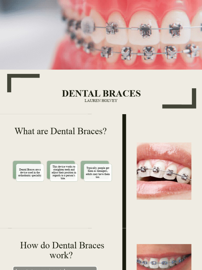 132 Powerpoint - Braces | PDF | Orthodontics | Dental Anatomy