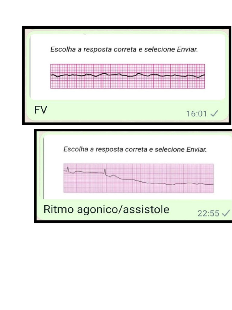 Resumo de Ritmos ACLS 2024 | PDF
