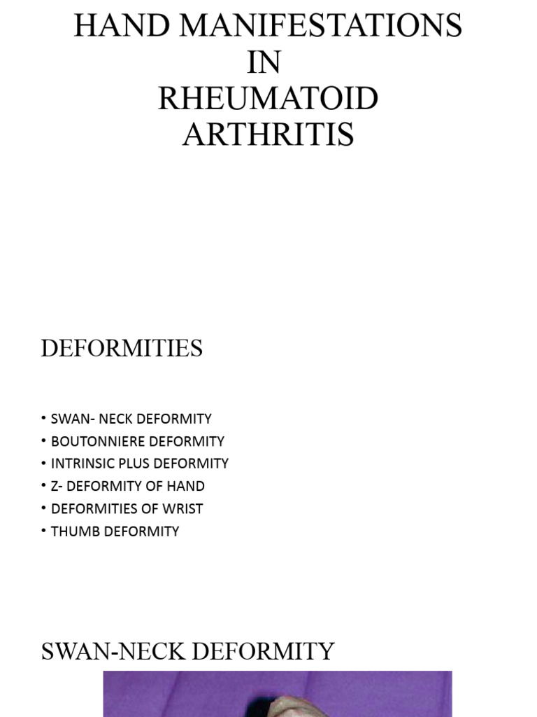 Rheumatoid Arthritis Hand Deformities | PDF | Anatomical Terms Of ...