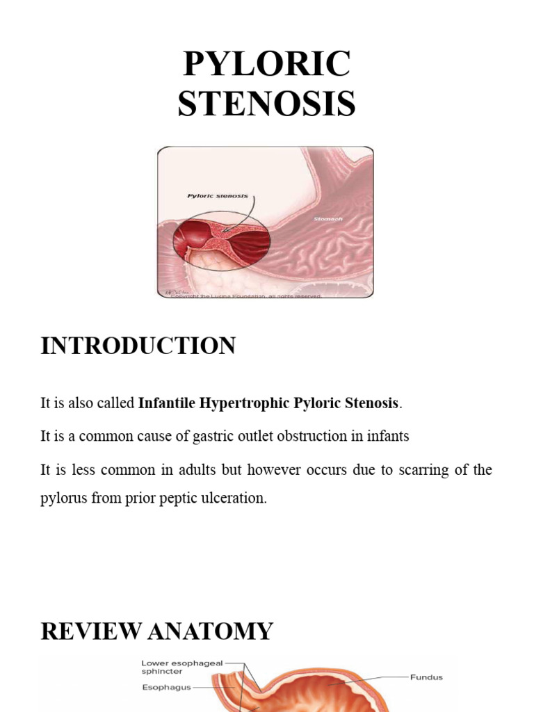 Pyloric Stenosis | PDF | Stomach | Digestive Diseases