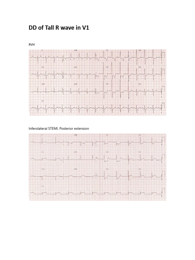 ECG Course Miscllaneous | PDF | Electrocardiography | Myocardial Infarction