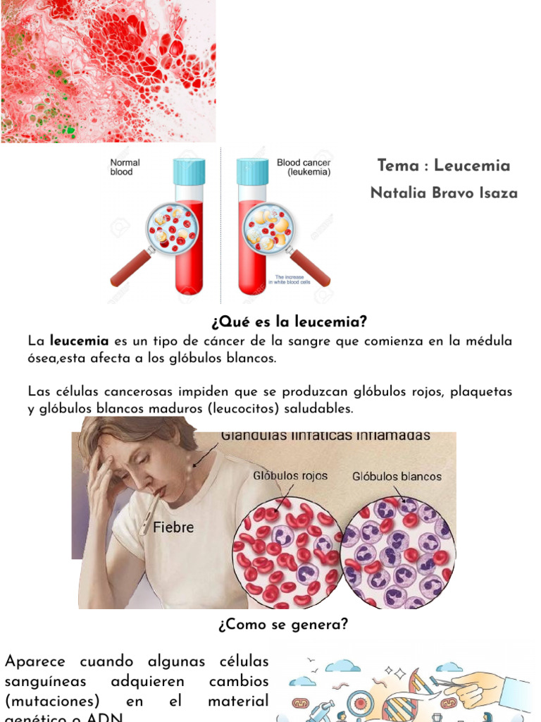 Exposición Leucemia | PDF | Leucemia | Medicina CLINICA