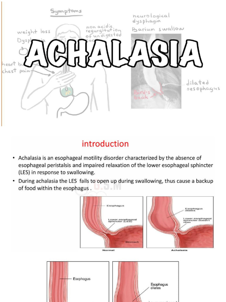 Achalasia: Symptoms, Diagnosis, and Treatment | PDF | Esophagus ...