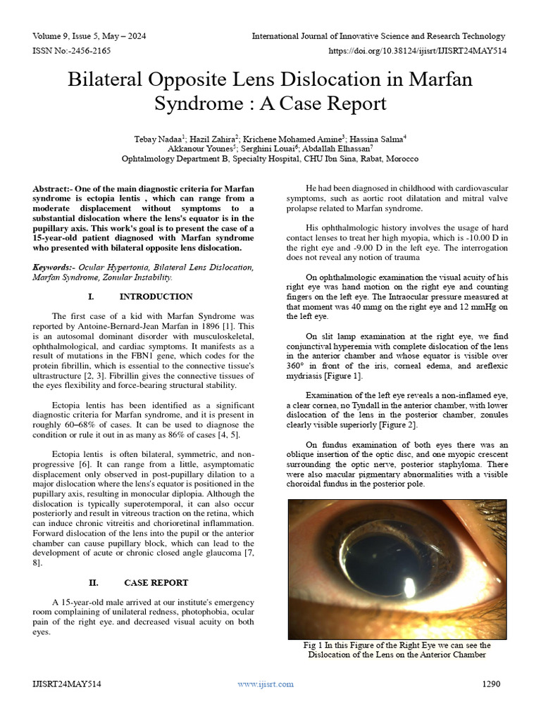 Bilateral Opposite Lens Dislocation in Marfan Syndrome: A Case Report ...