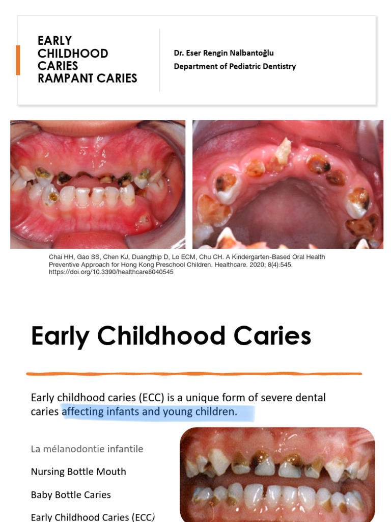 ECC and Rampant Caries.3rdYear | PDF | Human Tooth | Oral Hygiene