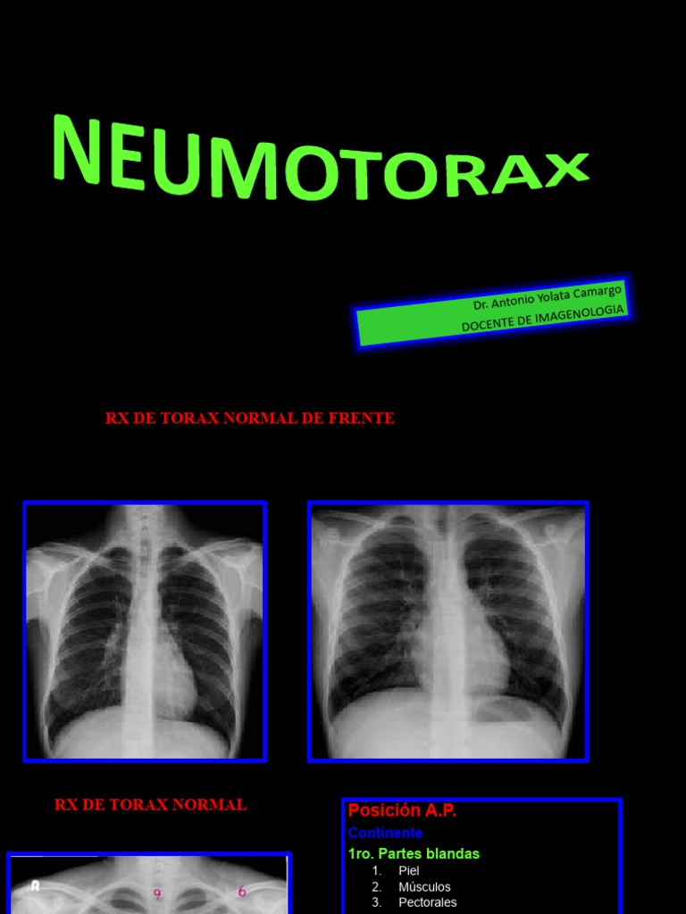 Segunda Clase Neumotorax Dx. Radiologico | PDF | Tórax | Pulmón