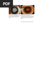 Nuclear Sclerosis Cataract Grading Guide | PDF