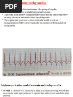Understanding Delta Waves in ECG | PDF | Medical Specialties | Causes ...