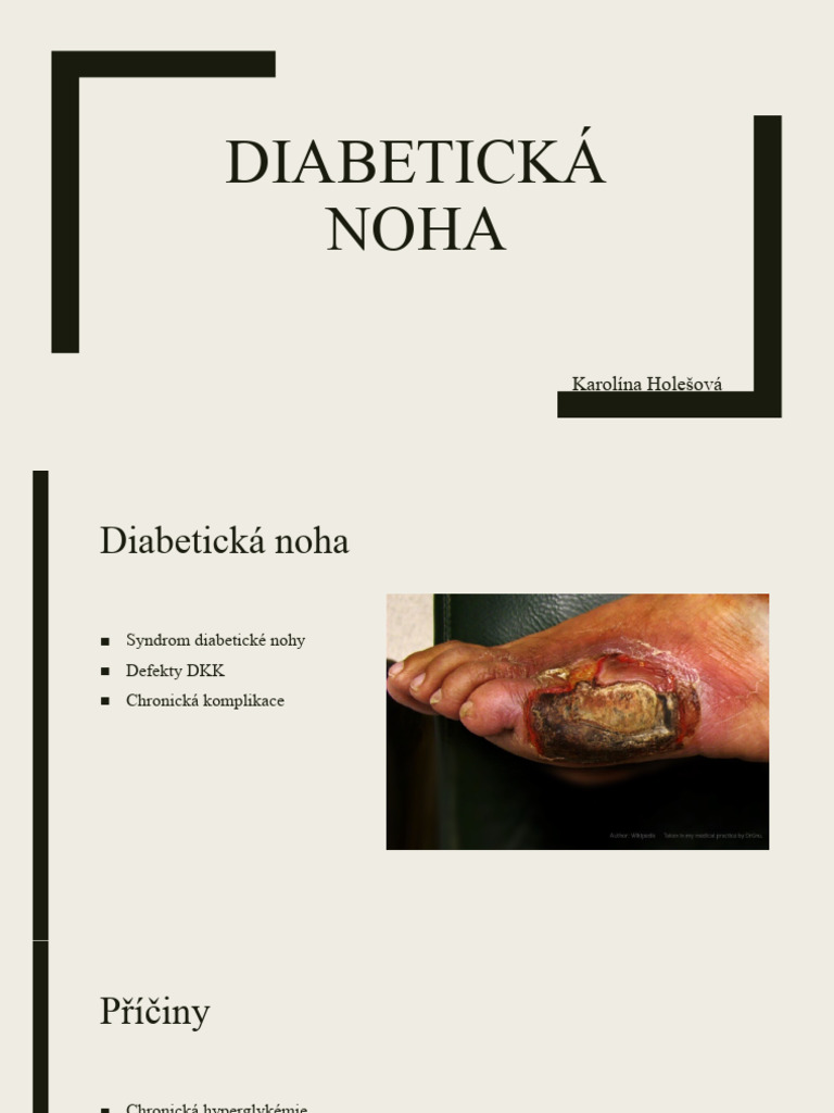 Diabetická Noha | PDF