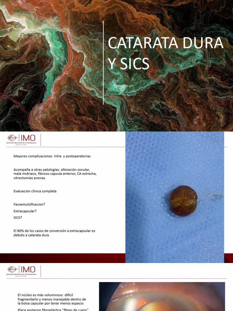 Catarata Dura y Sics Aby | PDF | Catarata | Cirugía