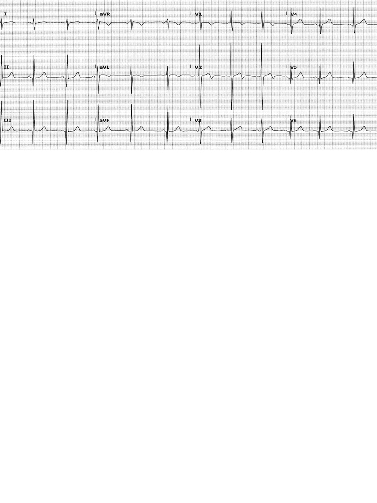 HCM-ECG - PNG 1,675×865 Pixels | PDF