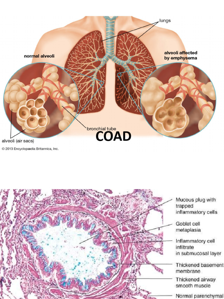 Copd Gold 2021 Cme | Download Free PDF | Chronic Obstructive Pulmonary ...