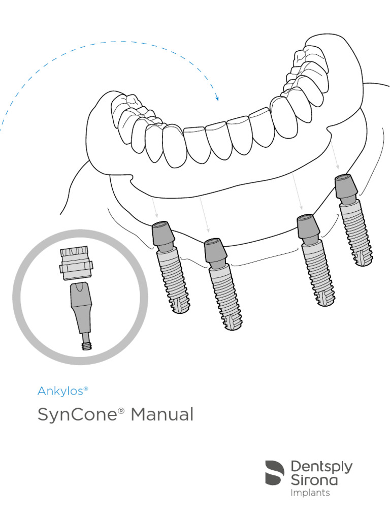 32670038-USX-1612 ANKYLOS Syncone Manual - LR | PDF | Dental Implant ...