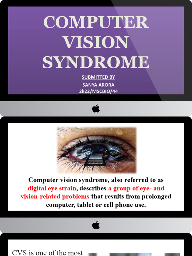Computer Vision Syndrome-Final | PDF