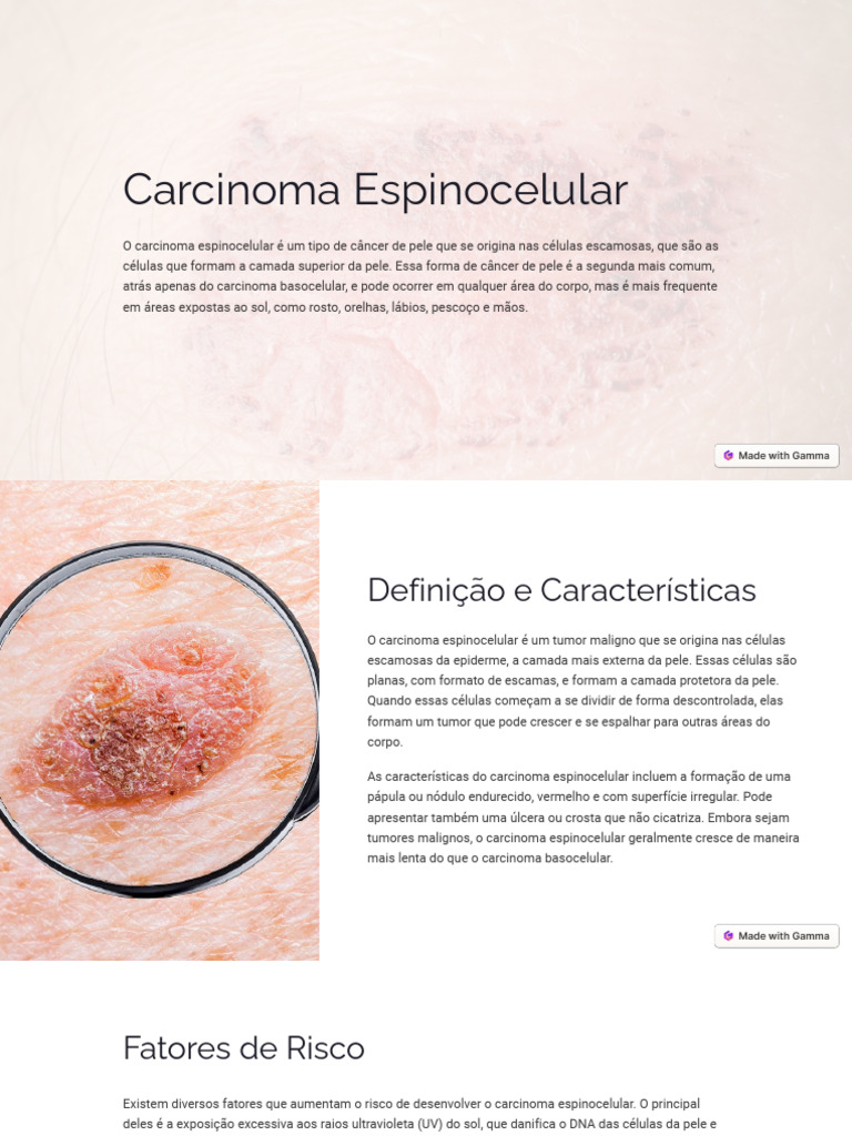 Carcinoma Espinocelular | PDF | Carcinoma | Câncer