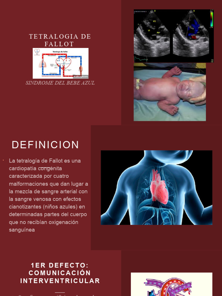 Tetralogia de Fallot | PDF | Corazón | Defecto cardiaco congenito