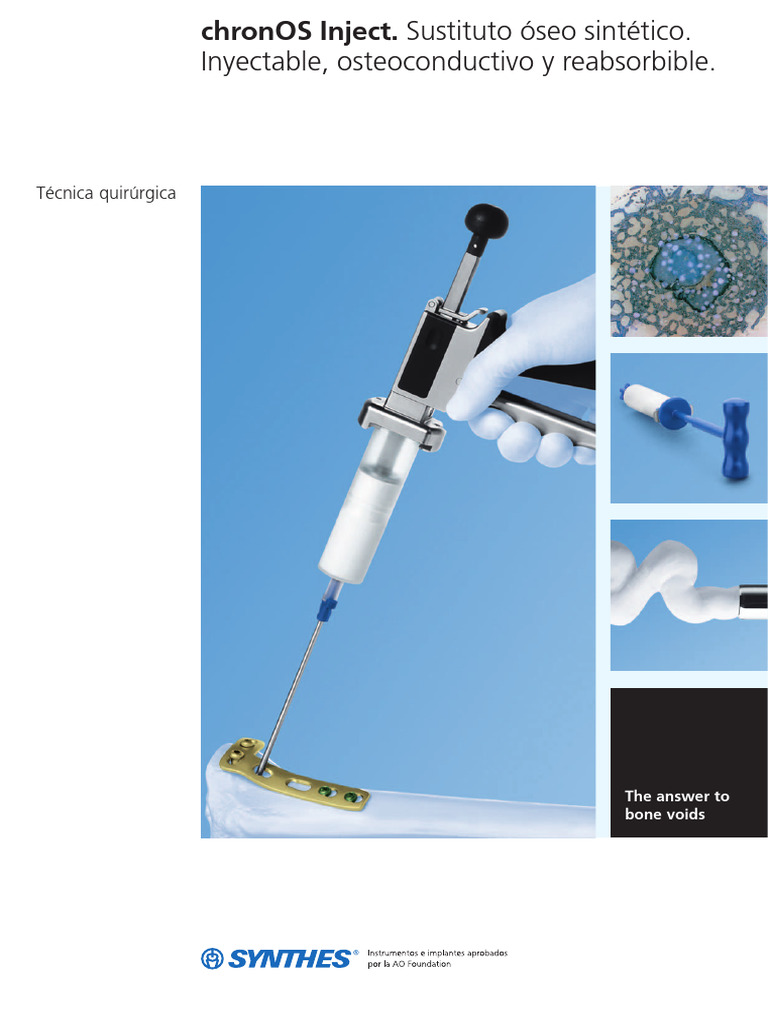 Uso de chronOS Inject en osteoclisis | PDF | Hueso | Inyección (medicina)