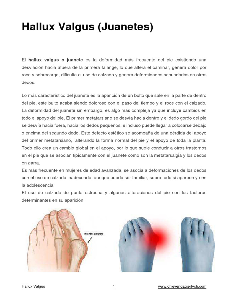 Tratamiento y causas del Hallux Valgus | PDF | Dedo del pie | Medicina ...