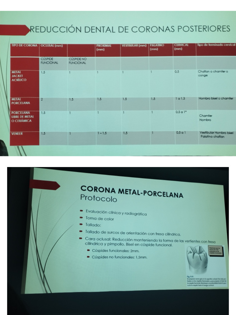 T5 Coronas Completas Posteriores | PDF