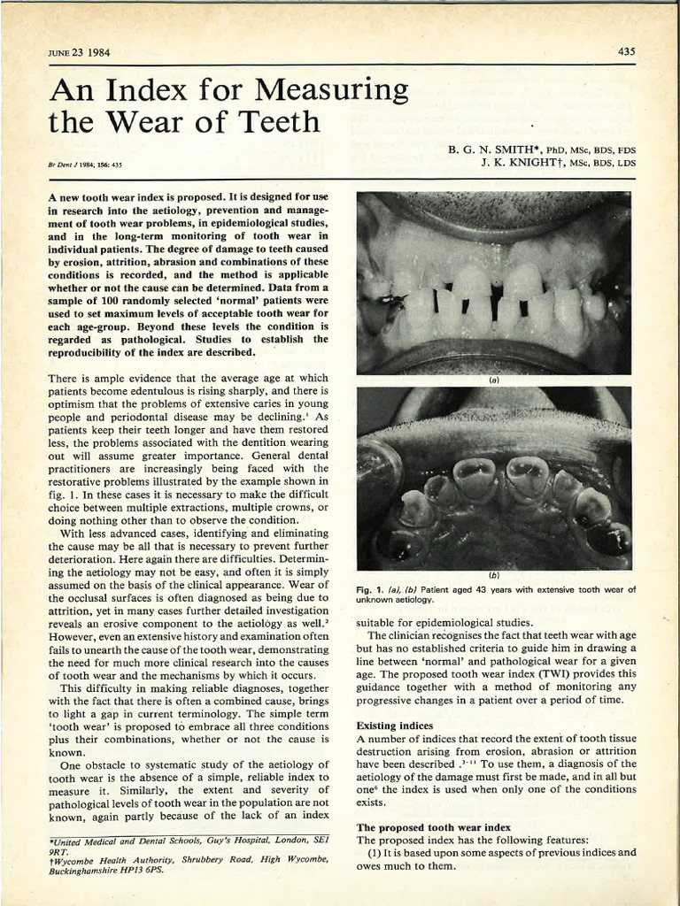 Smith BDJ 1984 435 | PDF