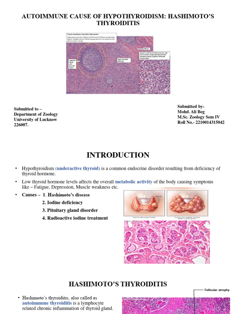 Hashimoto's Thyroiditis Overview | PDF | Thyroid | Hypothyroidism