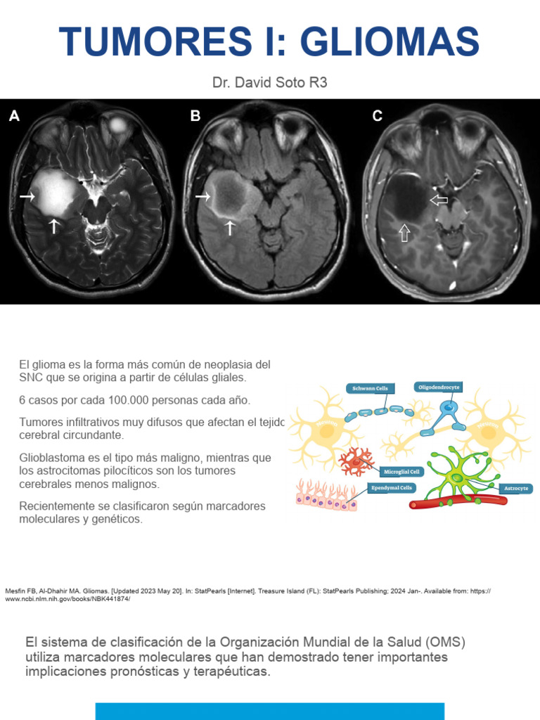 Tumores I_ Gliomas | Descargar gratis PDF | Glioma | Tumor cerebral