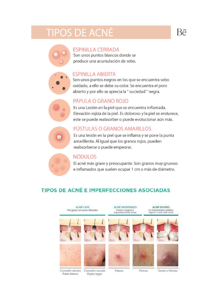 Tipos de Acne | PDF