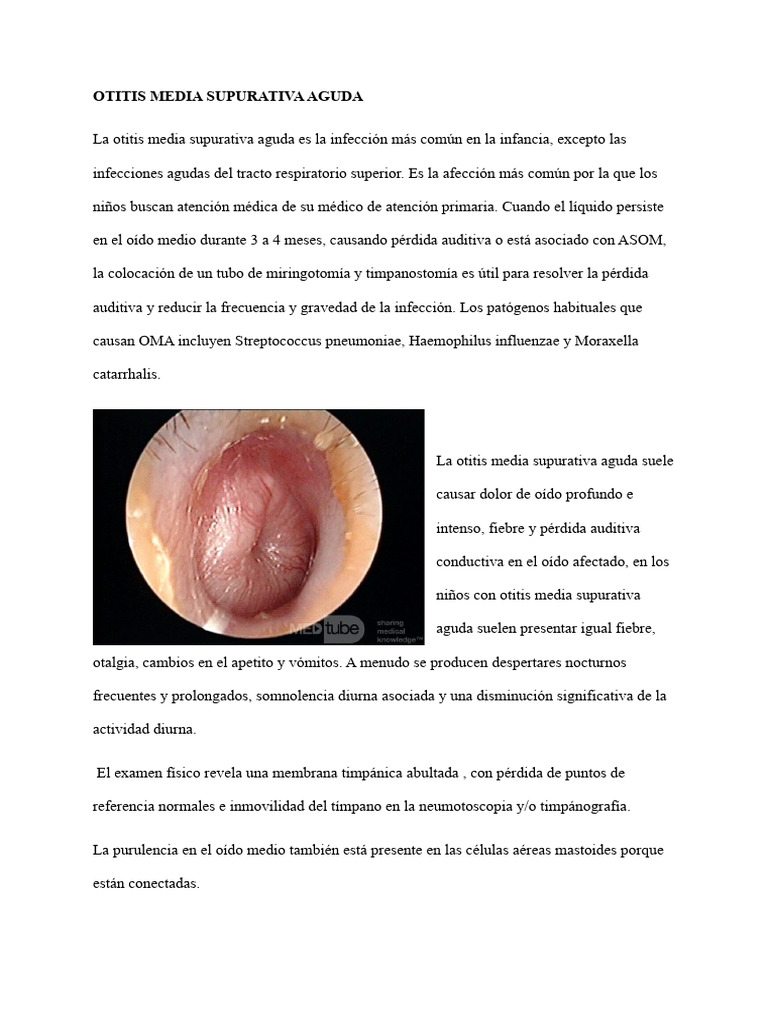 Otitis Media Supurativa: Diagnóstico y Tratamiento | PDF | Escuchando | Especialidades Medicas