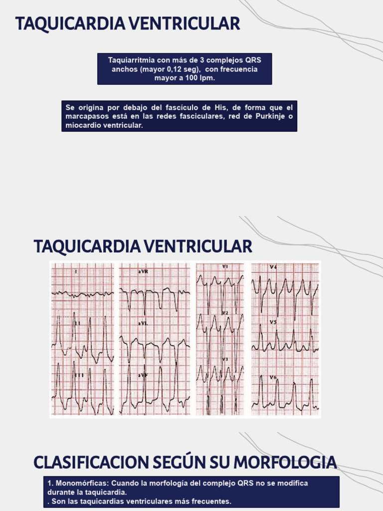 Taquicardia Ventricular | PDF