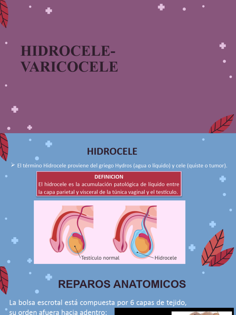 Hidrocele Varicocele | PDF | Especialidades Medicas | Medicina CLINICA