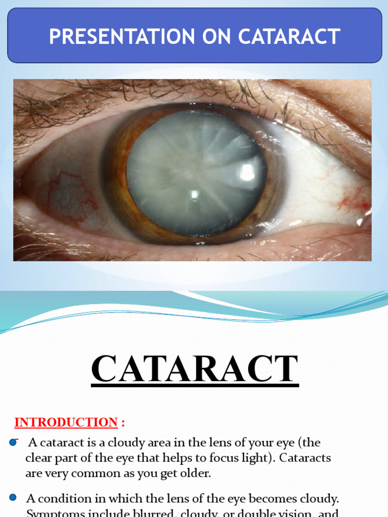 Presentation 1 | PDF | Cataract | Human Diseases And Disorders