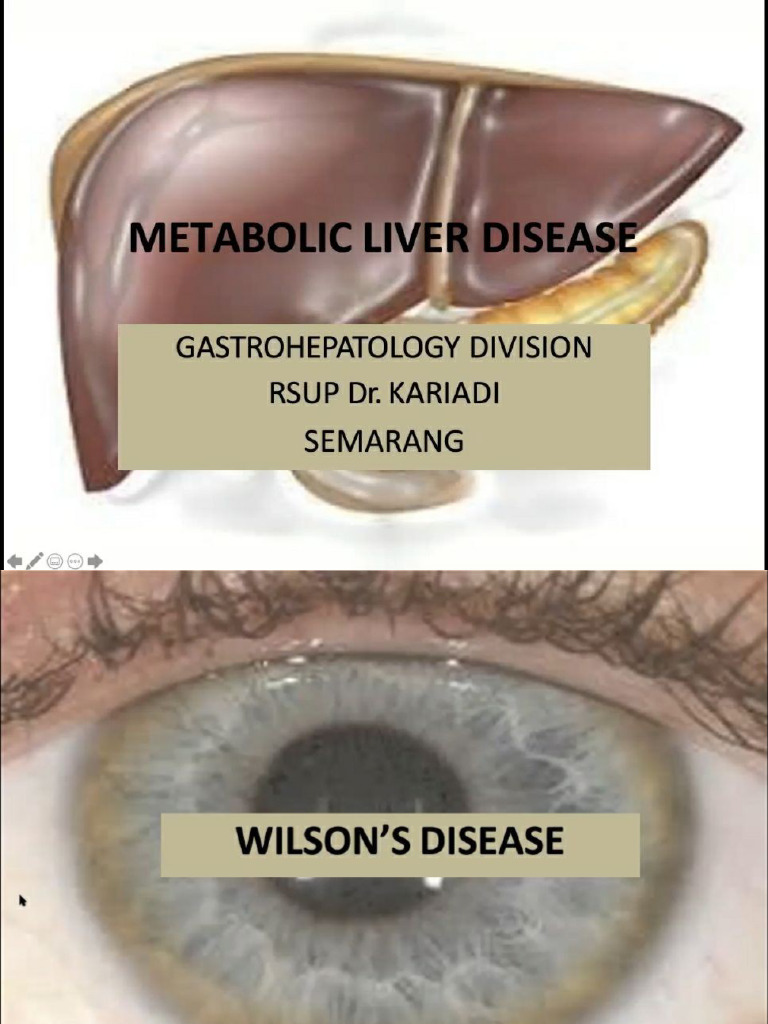 Epidemiologi Penyakit Wilson | PDF
