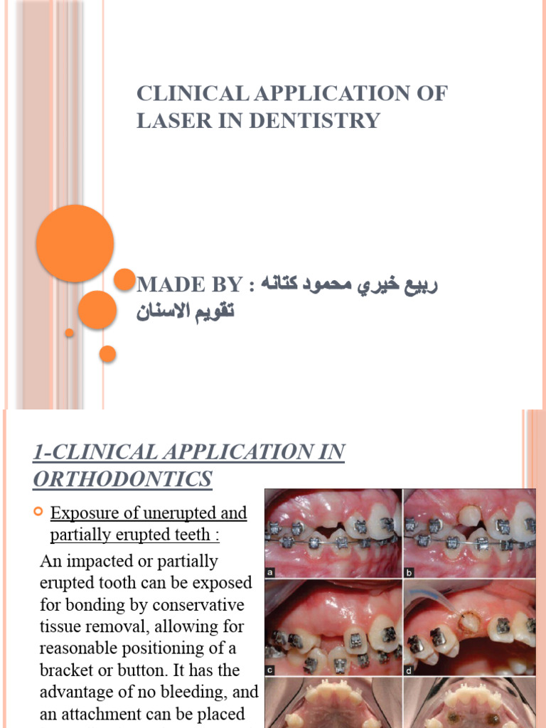 Clinical Application of Laser in Dentistry | Download Free PDF ...