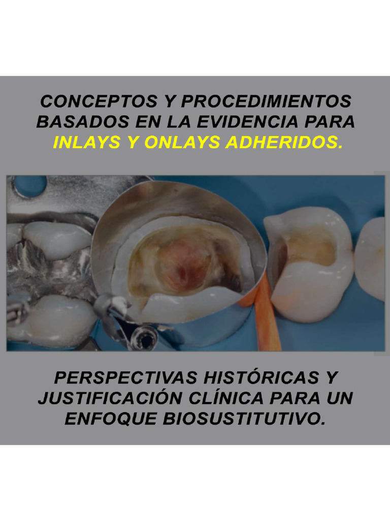 Conceptos_y_procedimientos_basados_en_la_evidencia_para_inlays_y | PDF