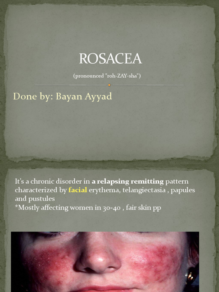Rosacea | PDF | Diseases And Disorders | Medical Specialties