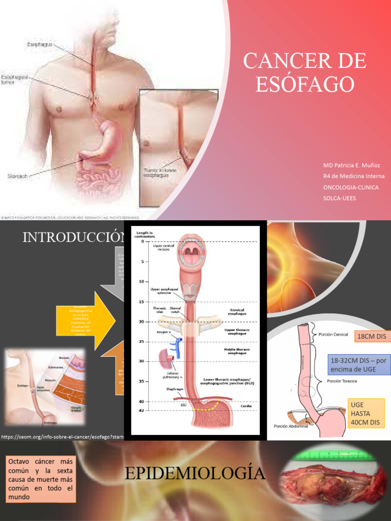 Onco | PDF | Estómago | Cáncer