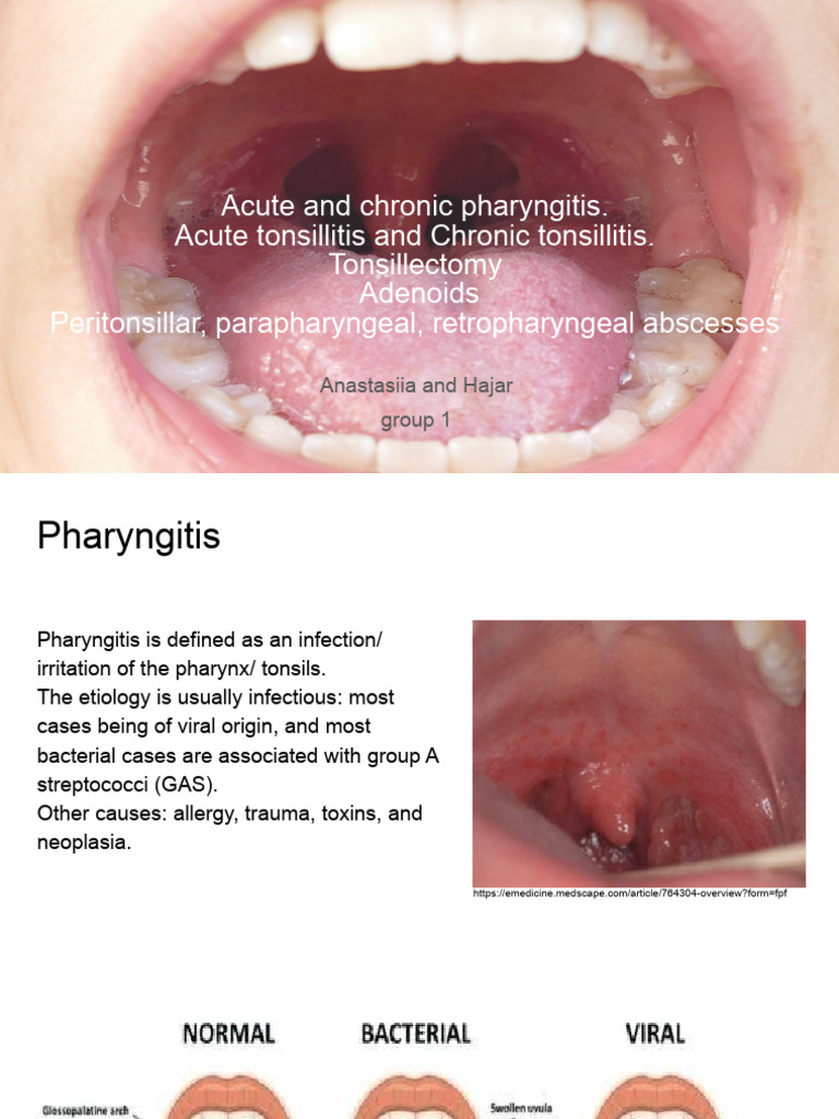Topic 5 - Acute and Chronic Pharyngitis | Download Free PDF | Lymphatic ...