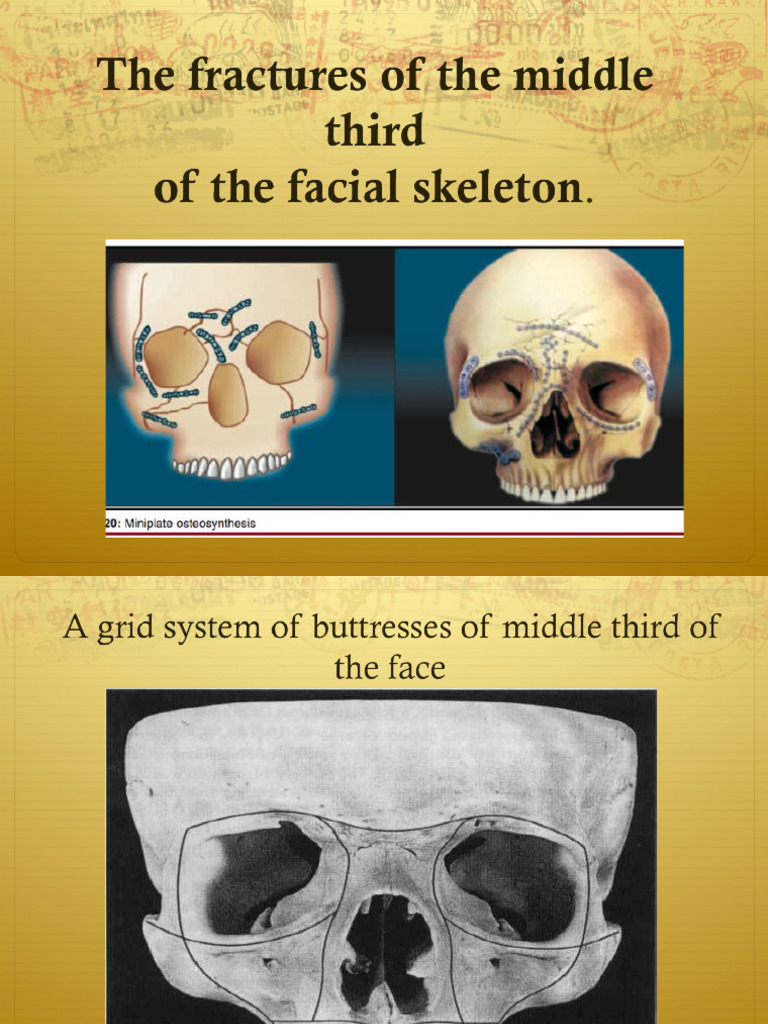 Part 5. the Fractures of the Middle Third of the 2 | PDF