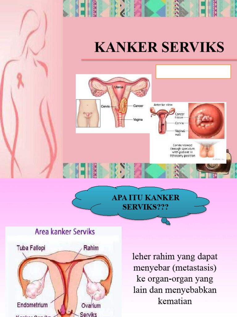 Ppt_kanker_serviks | PDF