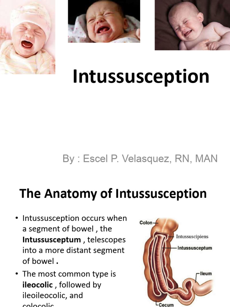 Intussusception | PDF | Gastroenterology | Medical Specialties