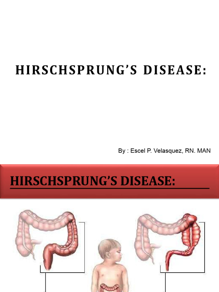 Hirschsprung | Download Free PDF | Gastroenterology | Clinical Medicine
