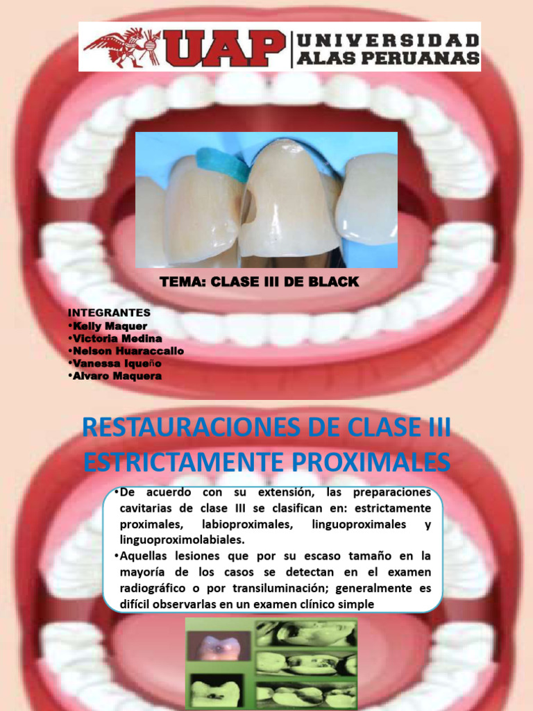 CLASE III de Black | PDF | Compuesto Dental | Boca