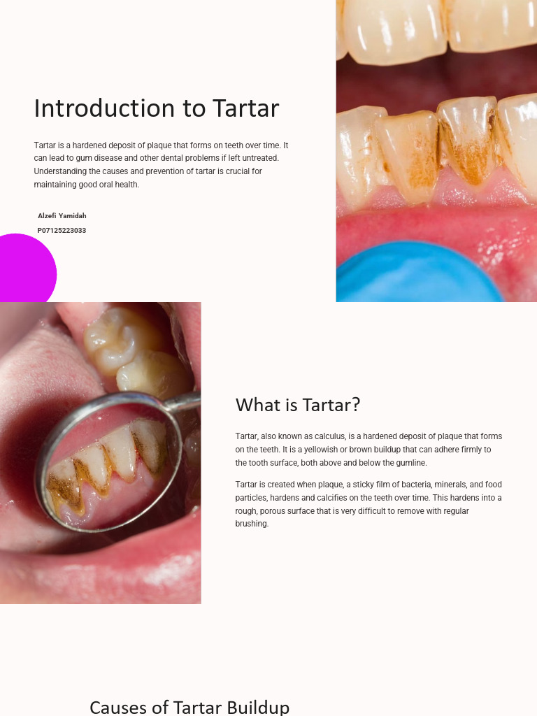 Introduction To Tartar 1 | PDF | Human Tooth | Oral Hygiene