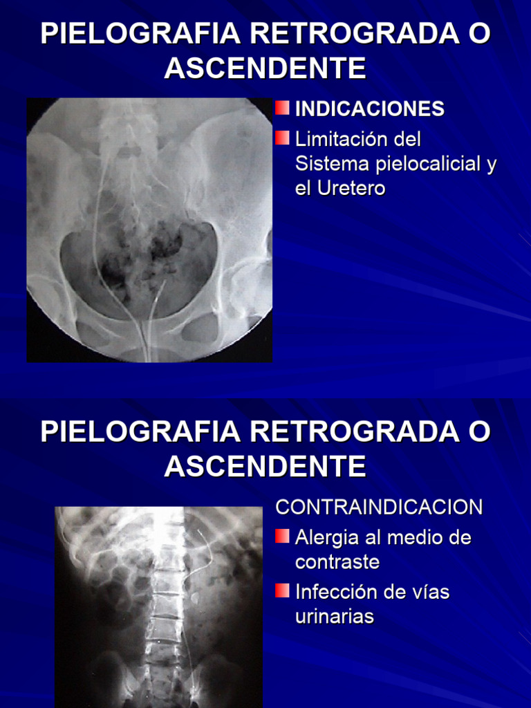 Pielografia Retrograda o Ascendente | PDF | Especialidades Medicas ...