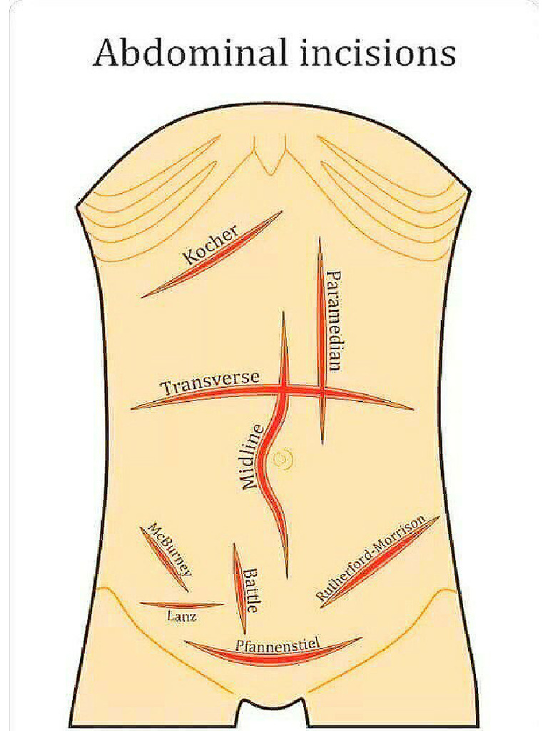 Abdominal Incisions | PDF