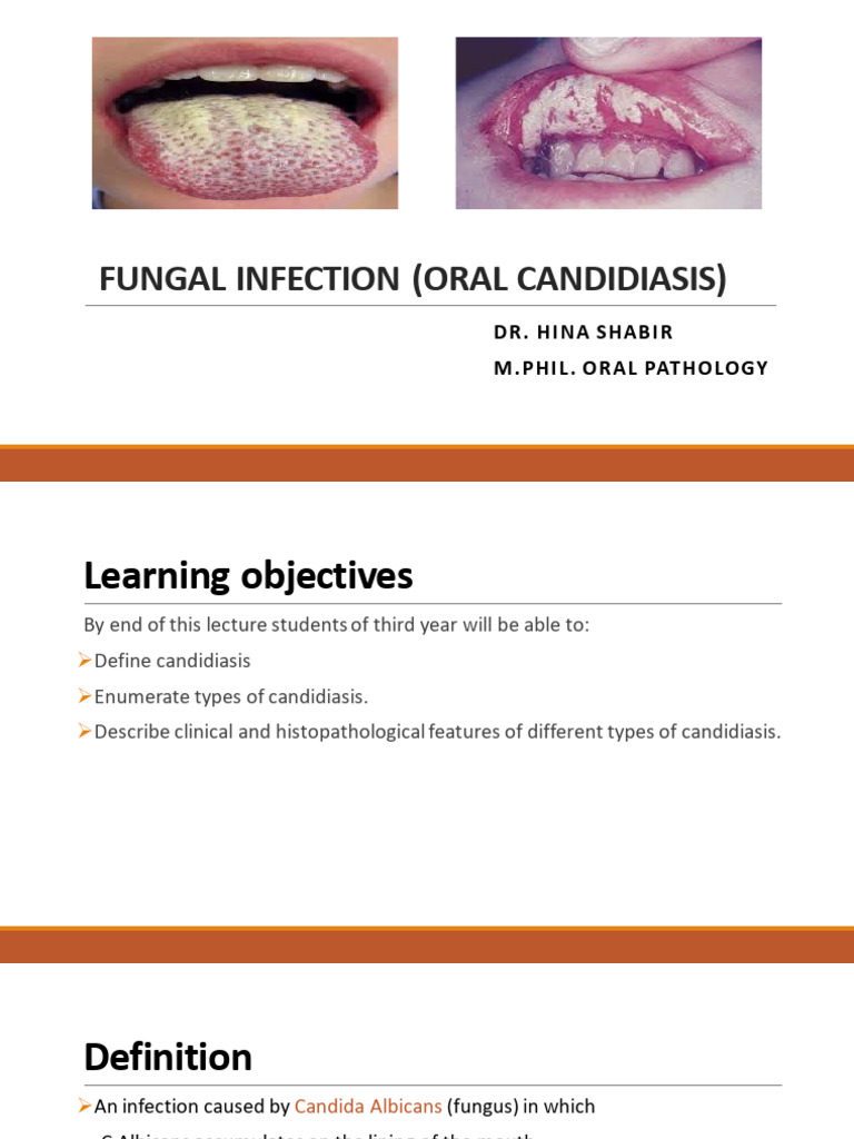 Understanding Oral Candidiasis Types | PDF | Candidiasis | Clinical ...