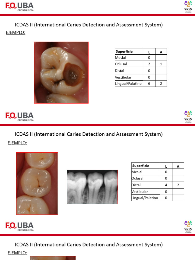 ICDAS II - Ejemplos | PDF | Tooth | Mouth