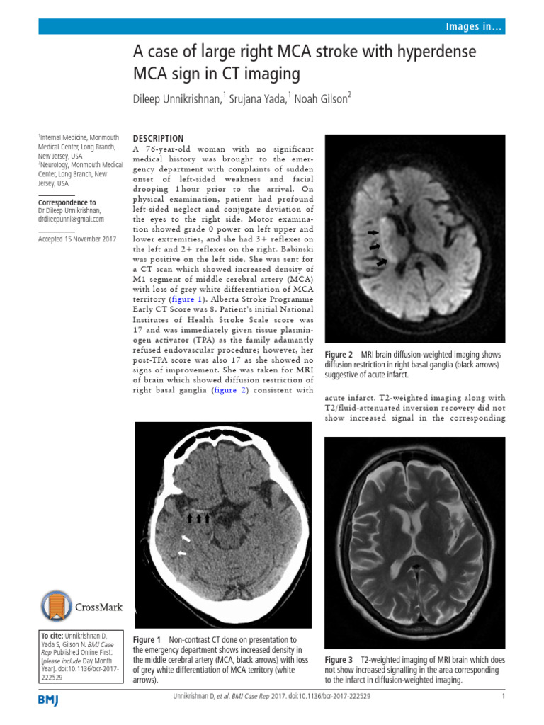 Case Report Mca | PDF | Stroke | Magnetic Resonance Imaging