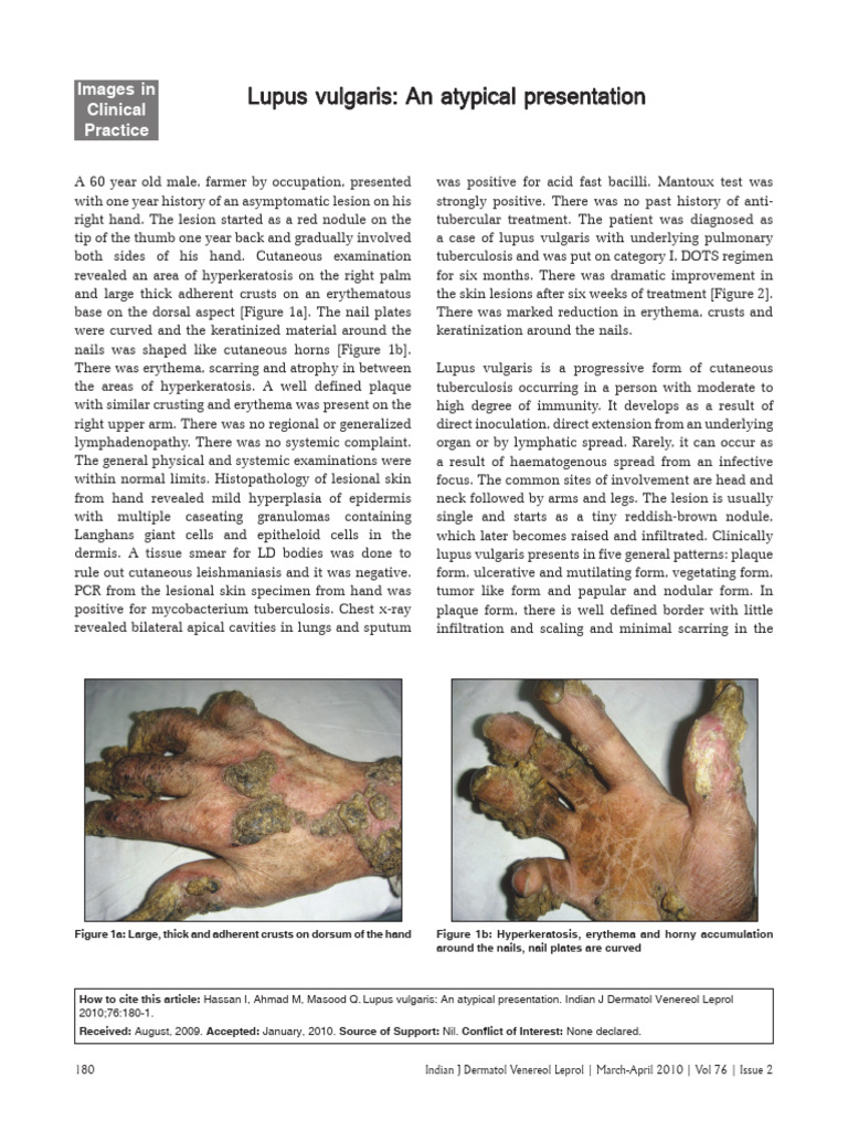 Lupus Vulgaris - An Atypical Presentation | PDF | Tuberculosis ...